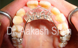 Dr. Aakash Shah's Exclusive Orthodontics, Orthodontics Clinic in Usman ...